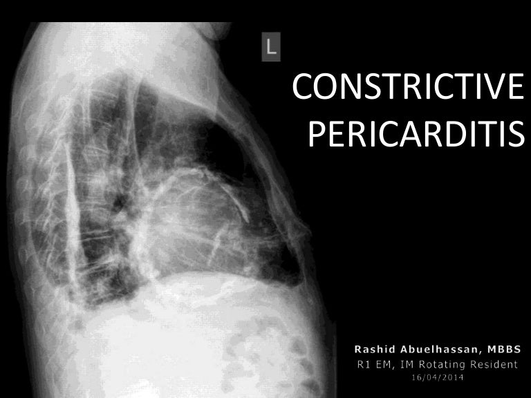 Constrictive Pericarditis