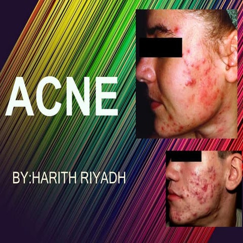 ACNE | PPT