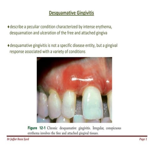 022.desquamative gingivitis | PDF