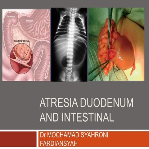 (02) Atresia Duodenum and management.ppt
