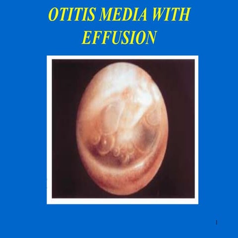 Otitis media with effusion steven feinberg sept 23 ,2004