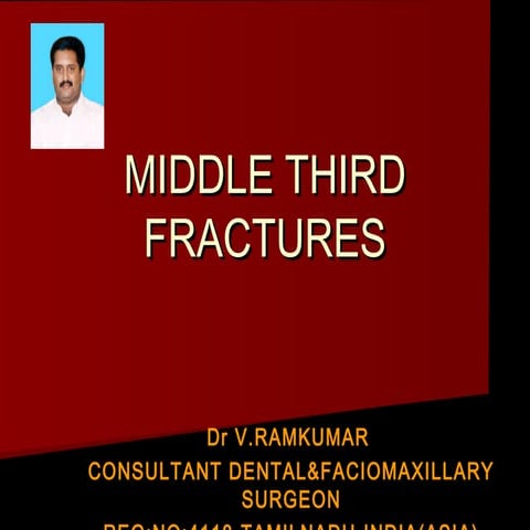 06.introduction to middle third fractures | PPT