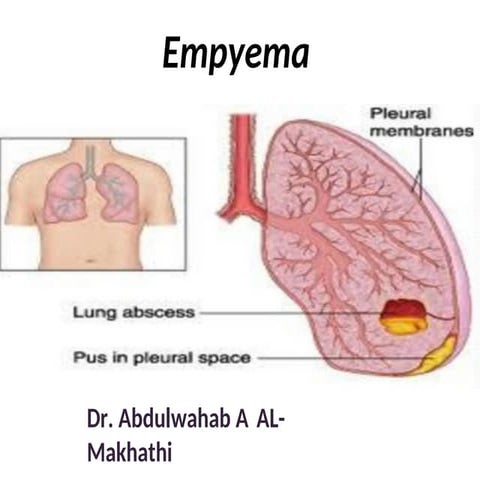 08- Empyema pdf (1)goood newnow in .pptx