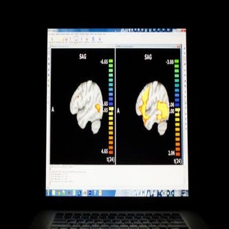Brain scan of a child on the autism spectrum | Curtis Cripe | PDF