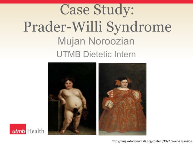 An over view of PRADER WILLI SYNDROME in children | PPTX