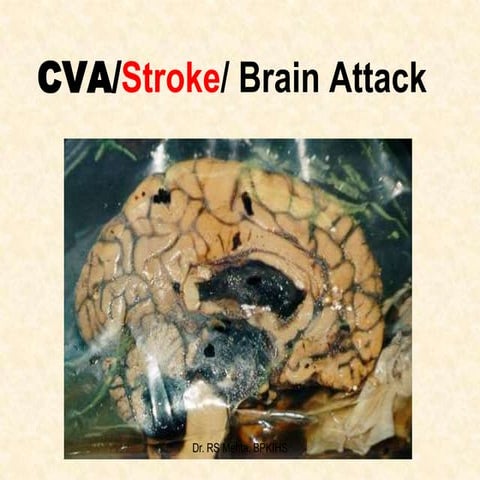 1. cva or stroke | PPT