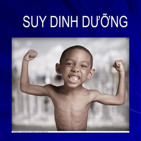 SUY DINH DƯỠNG | PDF