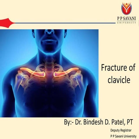 1. Fracture of Clavicle | PPT