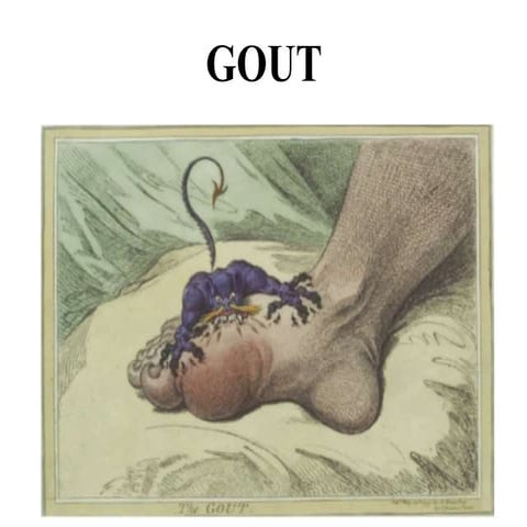 Gout-The King of diseases & the disease of Kings | PPTX
