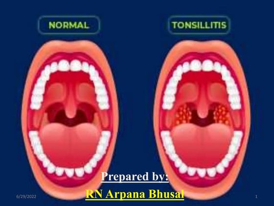 Nursing management of the patient with Tonsillitis PPT | PPTX