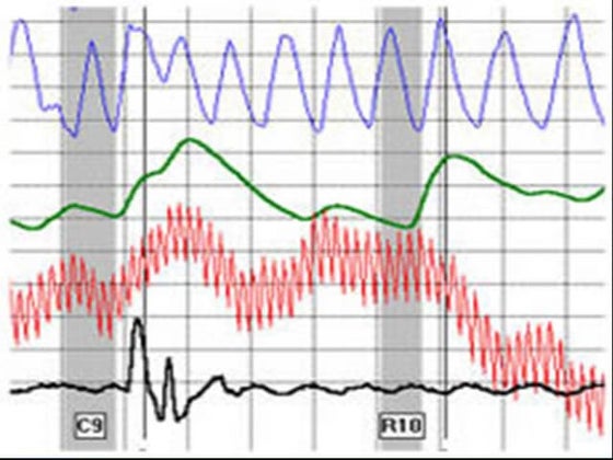 Art. 252 .Physical injuries inflicted in a tumultuous affray | PPTX