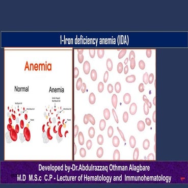1 iron deficiency anemia (ida) | PDF