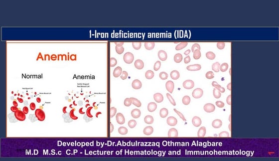 Sideroblastic anemia.pptx |Hematology| | PPT