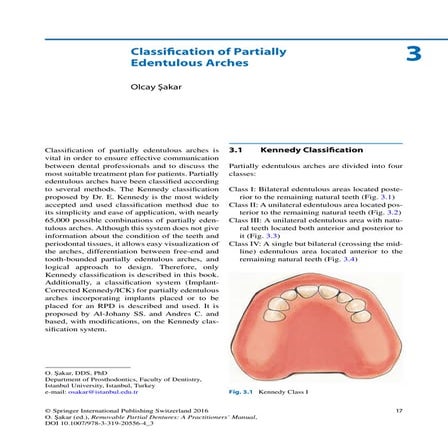 Classification of partially edentulous space | PDF