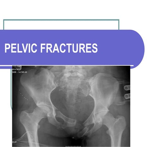 Fractures of Pelvic | PPT