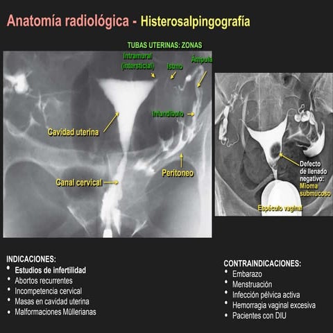 Histerosalpingografía: anatomía radiológica, zonas tubarias ...