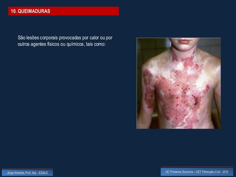 10 queimaduras