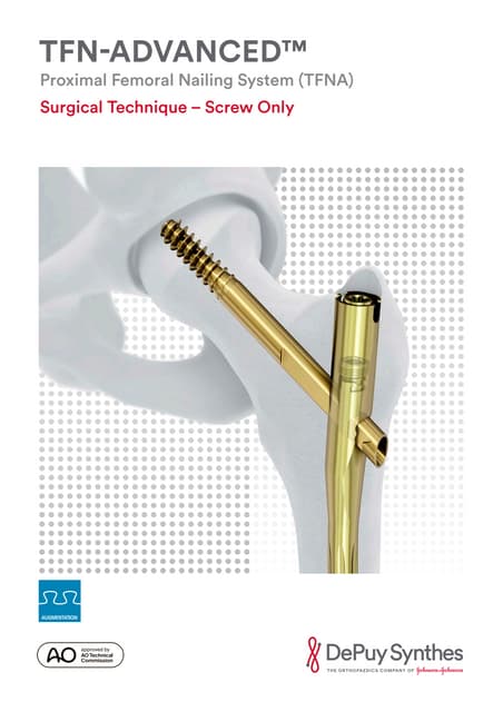 Dynamic Hip Screw Plating | PPT