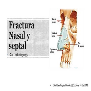 10 fractura nasal y septal | PPTX