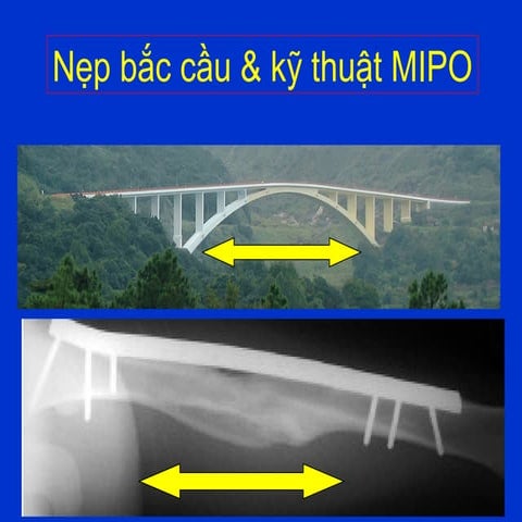 11. bridge plate and mipo tech v nese | PPT