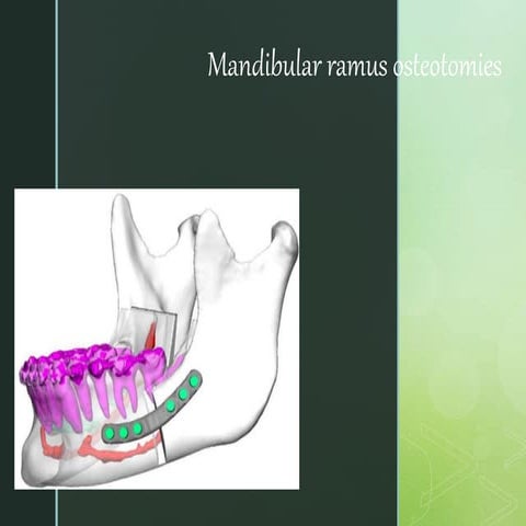11. Mandibular osteotomies psk.pptx