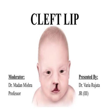 management of Cleft Lip, management of cleft lip and palate | PPTX