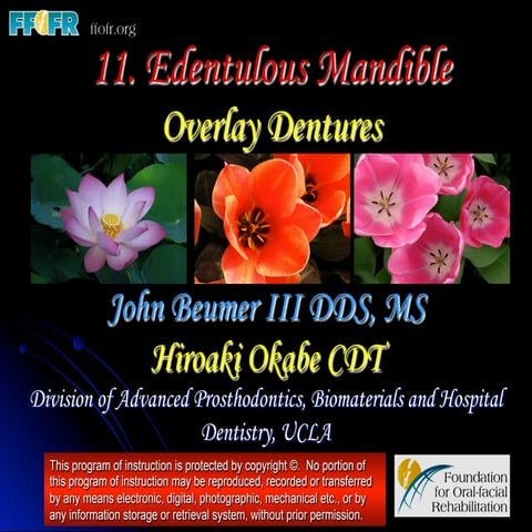 Edentulous Mandible - Overlay Dentures | PDF
