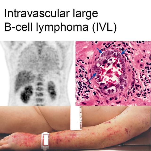 Intravascular large B-cell lymphoma (IVL) | PDF