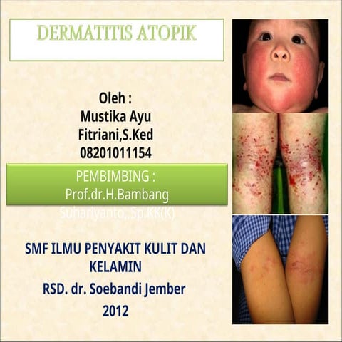 Dermatitis-Atopik. Dermatitis presentasion.ppt