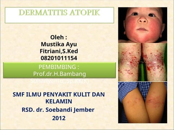 DERMATITIS ATOPI PRESENTASI RINA PURNAMA SARI | PPTX