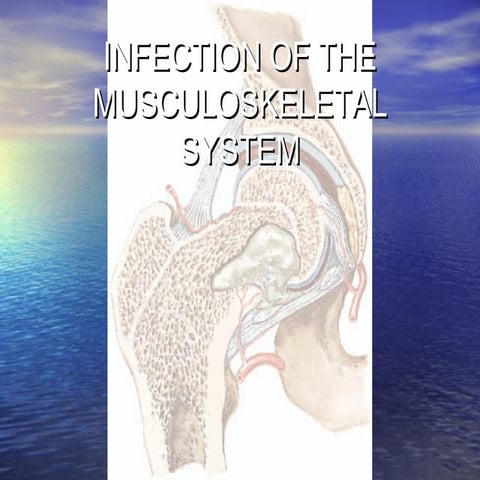 Infection of Musculoskeletal system | PPT