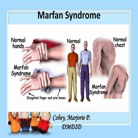 12 Cobey Marfan Syndrome Pptx