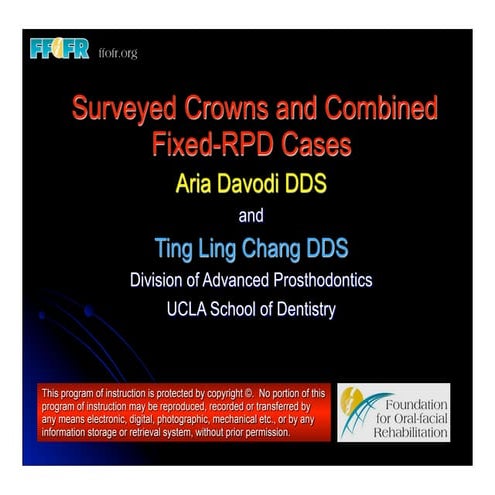 12.(new)surveyed crowns and combined fixed rpd cases | PDF