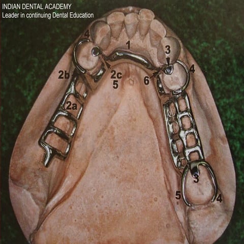 major connectors/ dental courses | PPT | Dental Health | Diseases and ...