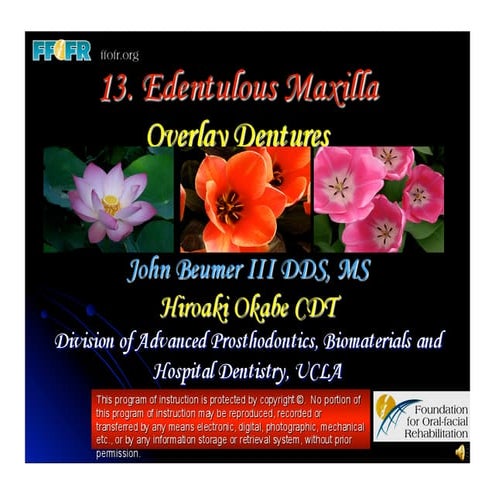 13.edent max overlay dentures | PDF