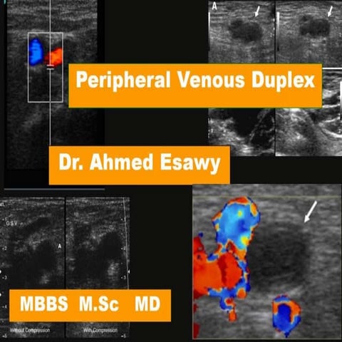 13 peripheral venous duplex ct mri in dvt dr ahmed esawy | PPTX