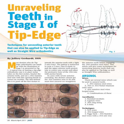 MBT wire sequence during orthodontic alignment and leveling | PPTX