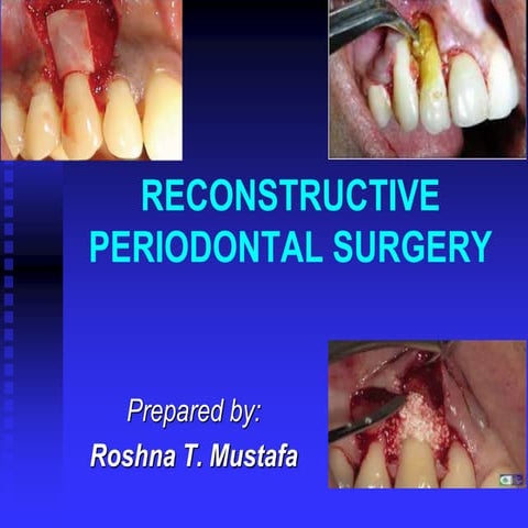 Ridge Augmentation Procedures | PPTX