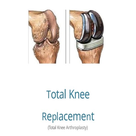 Total knee replacement powerpoint presentation.pptx
