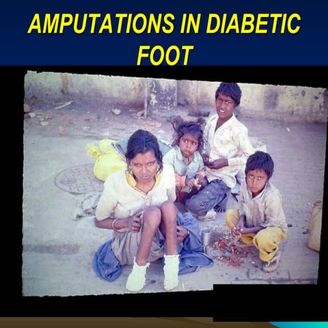 Toe and Partial Foot Amputations | PDF