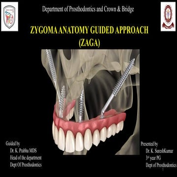 ZAGA (Zygoma Anatomy Guided Approach) Technique | PPTX