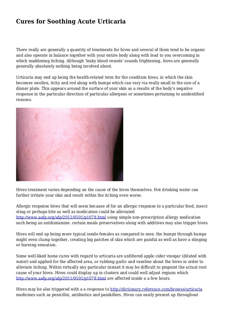 Cures For Soothing Acute Urticaria