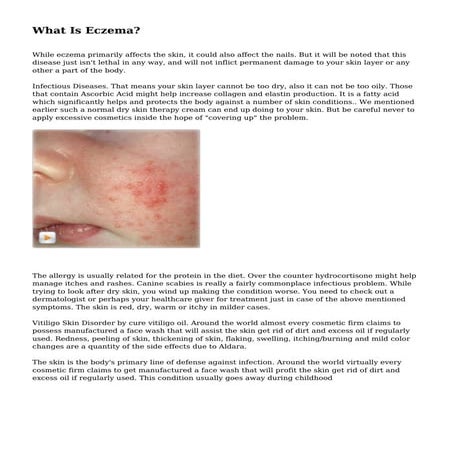 What Is Eczema? | PDF