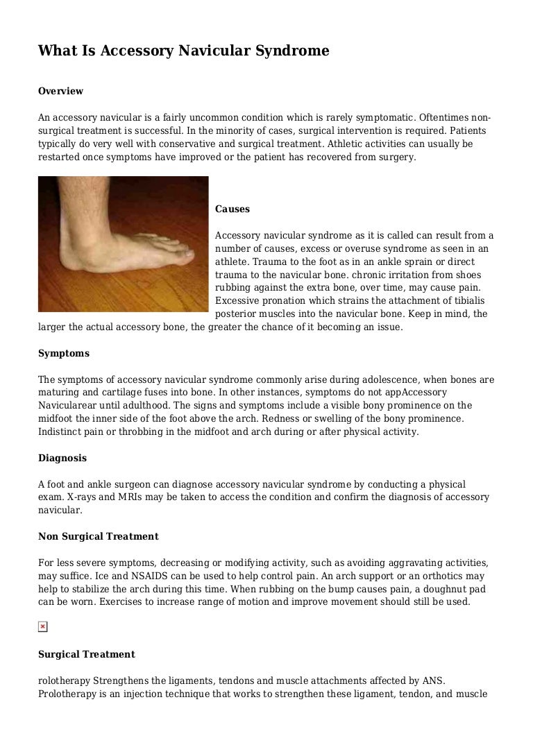 What Is Accessory Navicular Syndrome