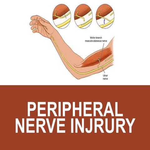 Approach to Wasted Hand (Neurology short case series).pptx