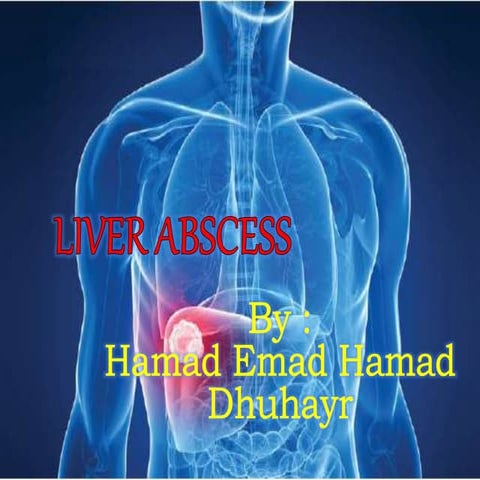 liver abscess | PPTX