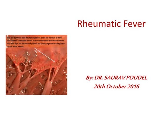 Rheumatic fever | PPT