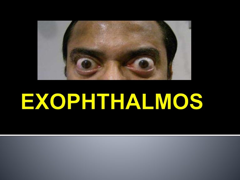 Exophthalmos