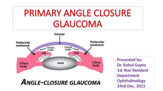 Glaucoma (opthalmology) | PPT