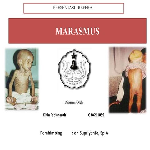 161983652-MARASMUS-PPT.pptx